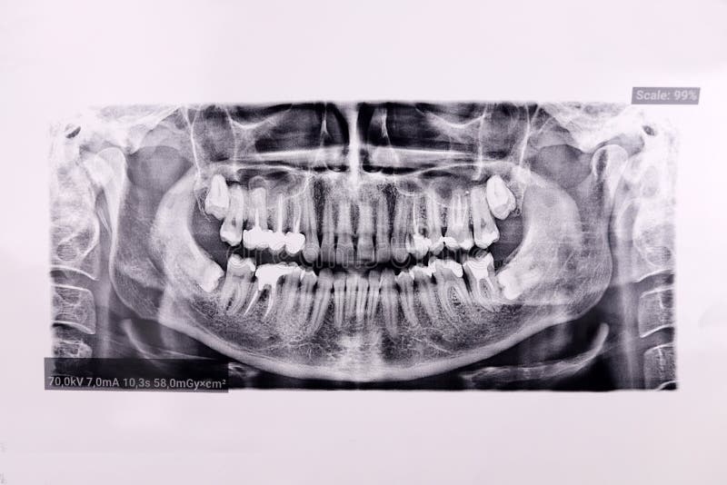 240 Wisdom Tooth Ray Dental Scan Stock Photos - Free & Royalty-Free ...