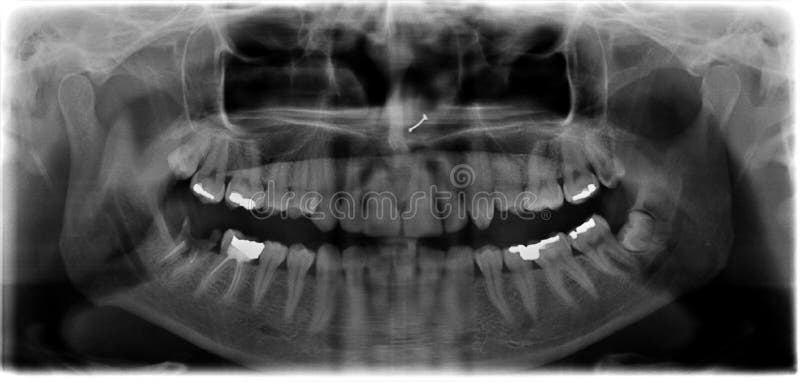 Panoramic Dental X-ray Stock Photography - Image: 15353522