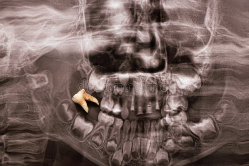 A Panoramic Image Shows Several Embedded and Impacted Teeth As on the ...