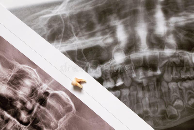 A Panoramic Image Shows Several Embedded and Impacted Teeth As on the ...