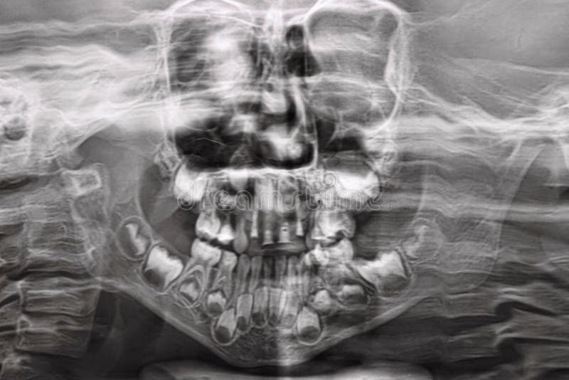 The Panoramic Image Shows Several Embedded and Impacted Teeth in Both ...