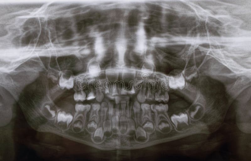 The Panoramic Image Shows Several Embedded and Impacted Teeth in Both ...