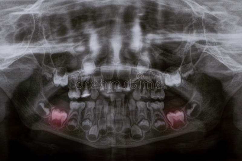 Panoramic X-ray of Both Jaws of Children's Teeth Stock Image - Image of ...