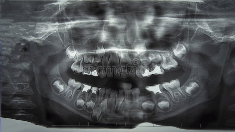 Panoramic X-ray of a Child`s Upper and Lower Jaw Teeth with Damaged ...