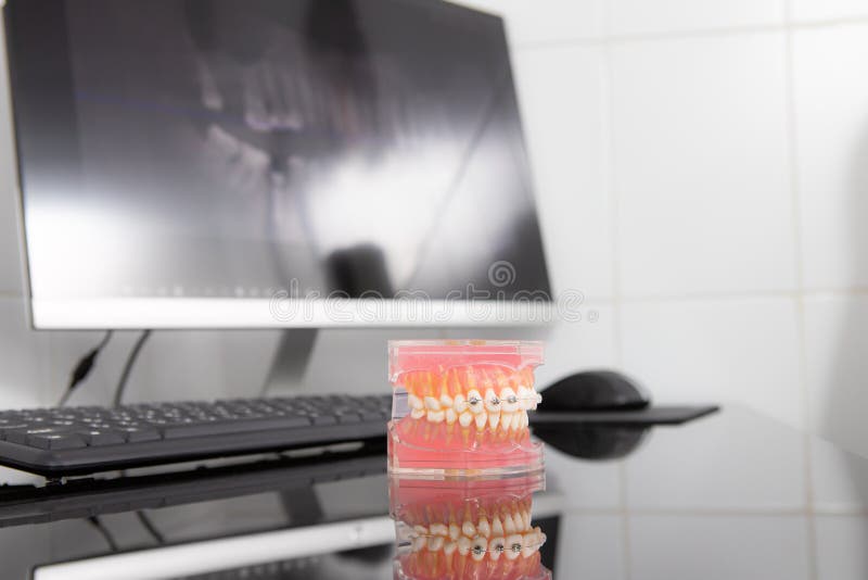 Panoramic X-ray on Computer Screen. Model of the Jaw on the Table Stock ...