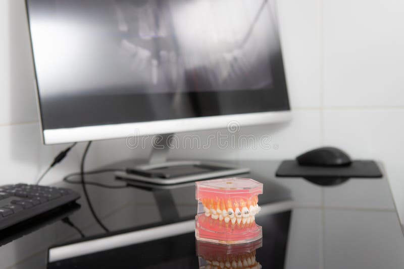 Panoramic X-ray on Computer Screen. Model of the Jaw on the Table Stock ...