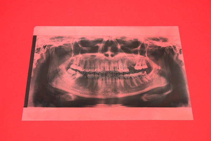 Panoramic X-ray Image of Teeth. Some Teeth Removed, Problem with Teeth ...