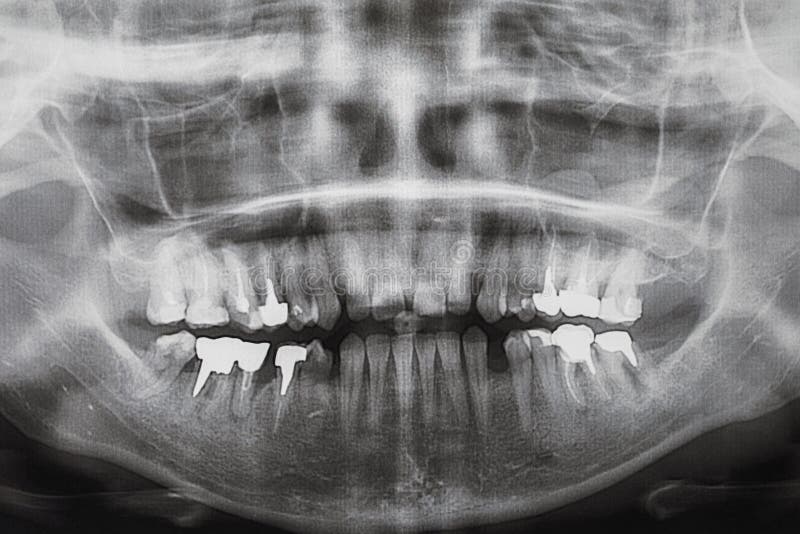 Panoramic X-ray of the Lower and Upper Jaw. Stock Photo - Image of ...