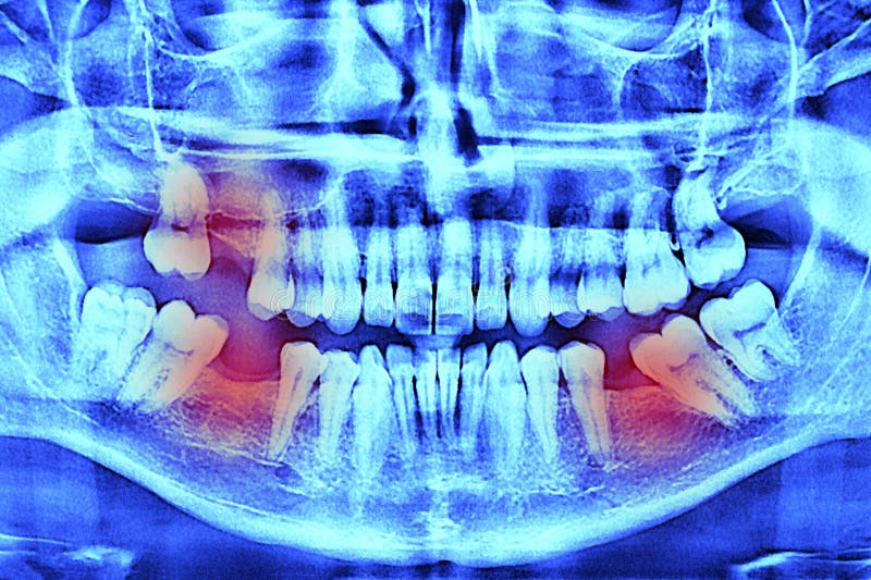 Panoramic X-ray of a Male Jaw without Several Teeth, Dentistry Stock ...
