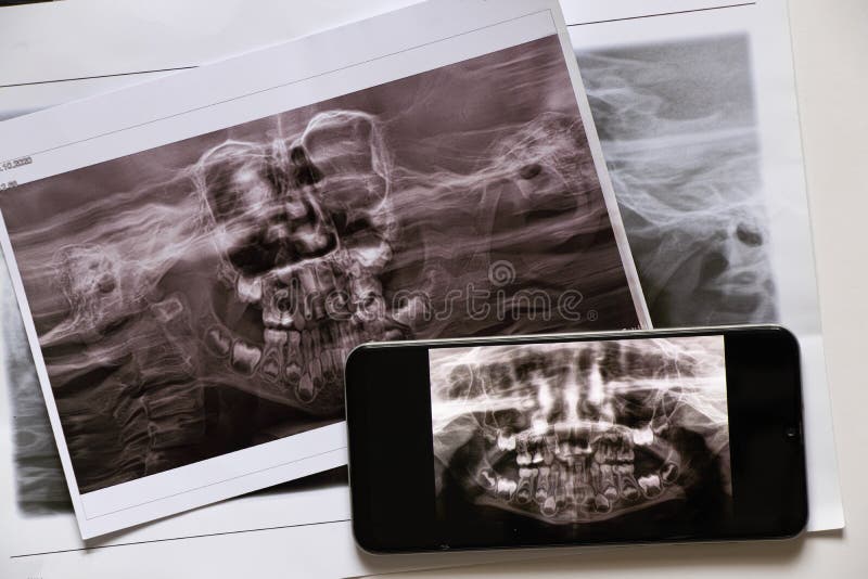 Panoramic Shot Shows Several Embedded and Impacted Teeth on Both the ...