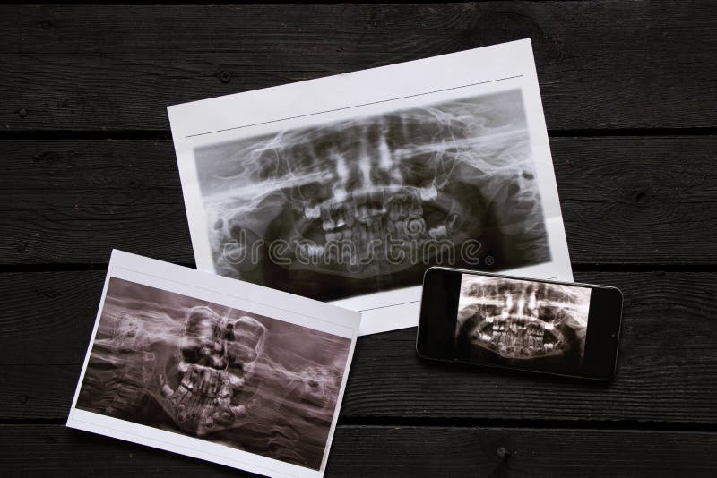 Panoramic Shot Shows Several Embedded and Impacted Teeth on Both the ...