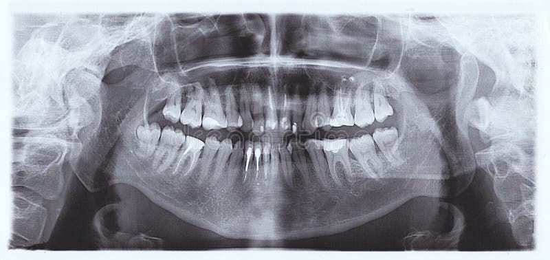 Panoramic Tooth Shot. Dental X-Ray Image of Teeth Stock Image - Image ...