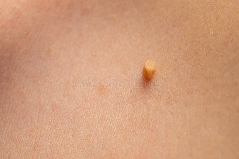 Papilloma on human skin stock photo. Image of carcinoma - 147009690