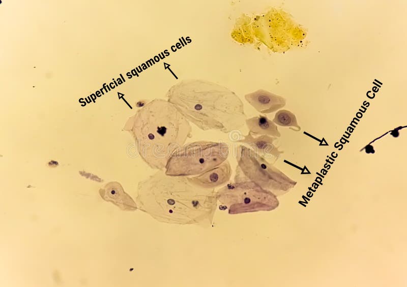 Paps Smear Under Microscopy Showing HPV Change. Stock Image - Image of ...
