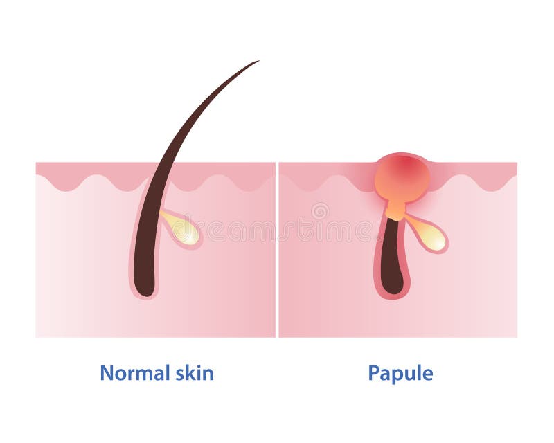 Pimple Acnes Stock Illustrations – 44 Pimple Acnes Stock Illustrations ...