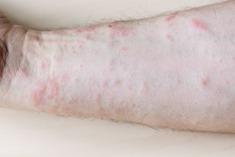 Papules on Inner Side of Forearm Close Up Stock Image - Image of itchy ...