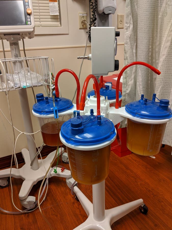 Paracentesis Abdomen Vochtophoping in Het Ziekenhuis Stock Foto - Image ...