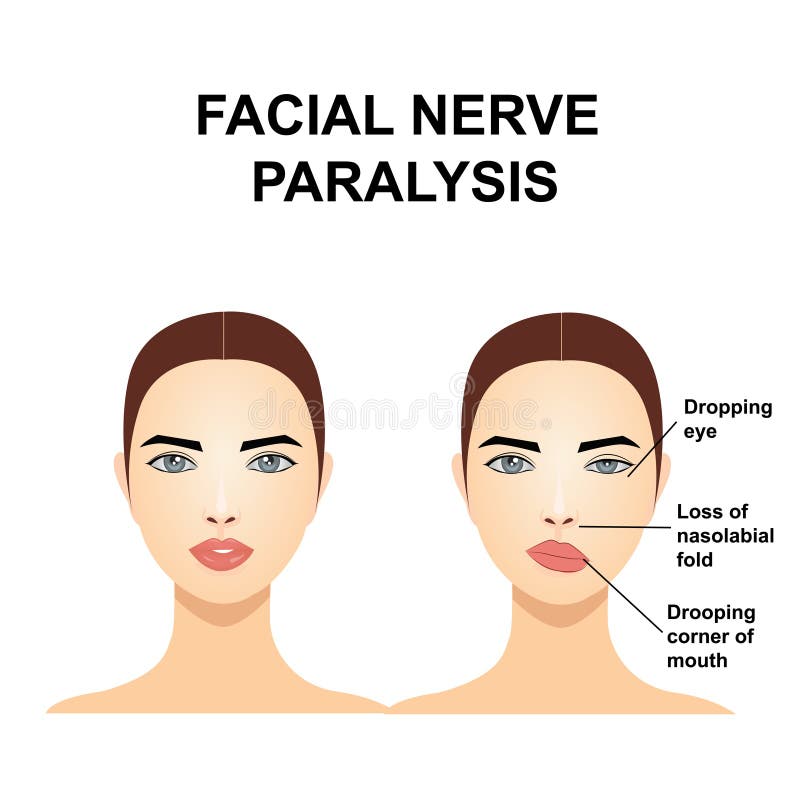 Facial Paralysis Stock Illustrations – 119 Facial Paralysis Stock ...