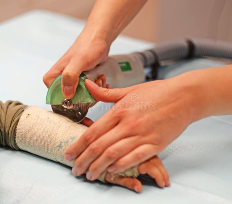 Removing Plaster from Arm with Saw Stock Image - Image of kisses, metal ...
