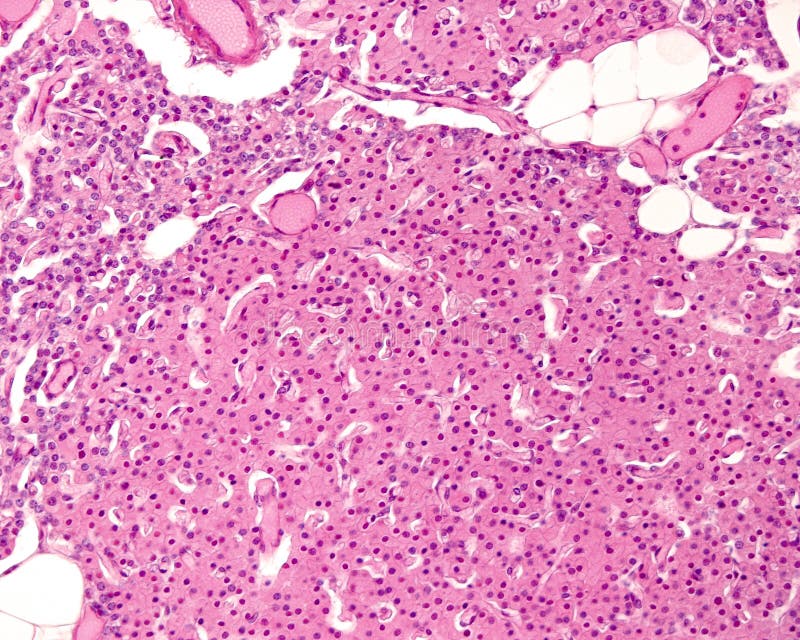 Parathyroid Gland. Oxyphilic Cells Stock Photo - Image of body, glands ...