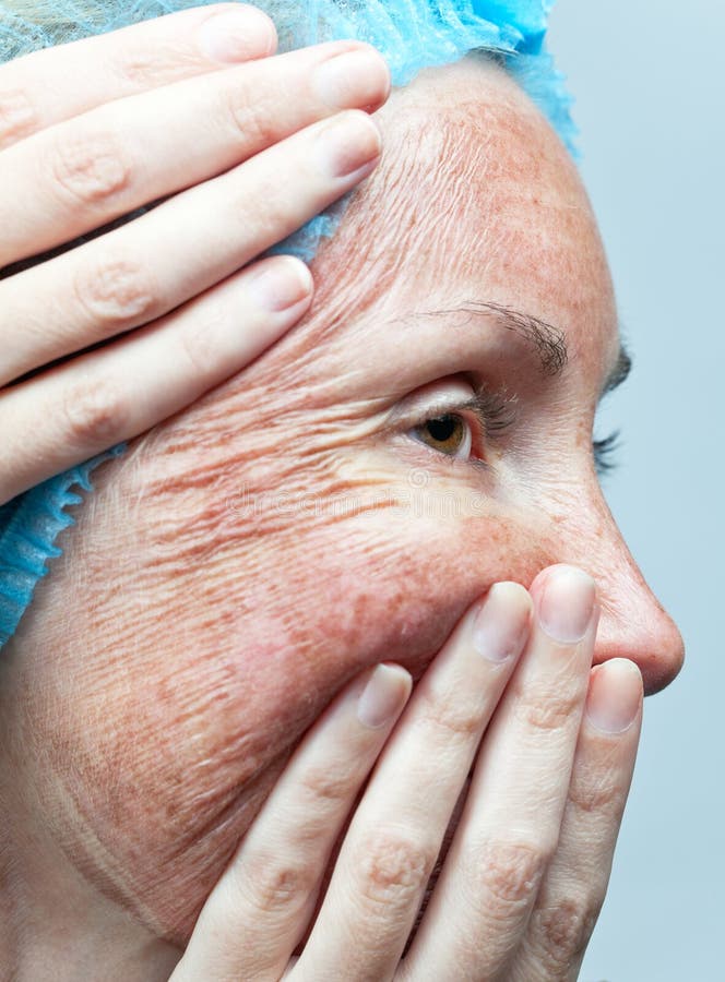 Parchment Skin before Rejection.Chemical Peeling. Stock Photo - Image ...