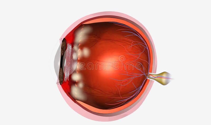 Corneal Disease Stock Illustrations – 155 Corneal Disease Stock ...