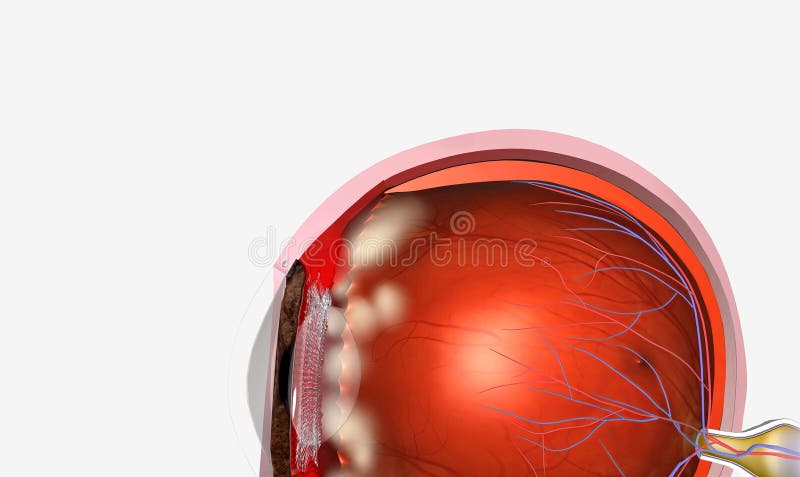 Pars Planitis Stock Illustrations – 3 Pars Planitis Stock Illustrations ...