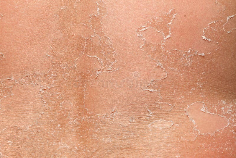 Peeling Sunburned Back stock image. Image of ozone, back - 16252339