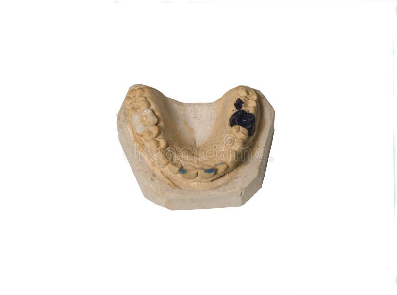 Partial Denture Mounted Plaster Study Model Stock Photos - Free ...