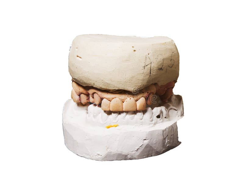 A Partial Denture Mounted on a Plaster Study Model Stock Image - Image ...