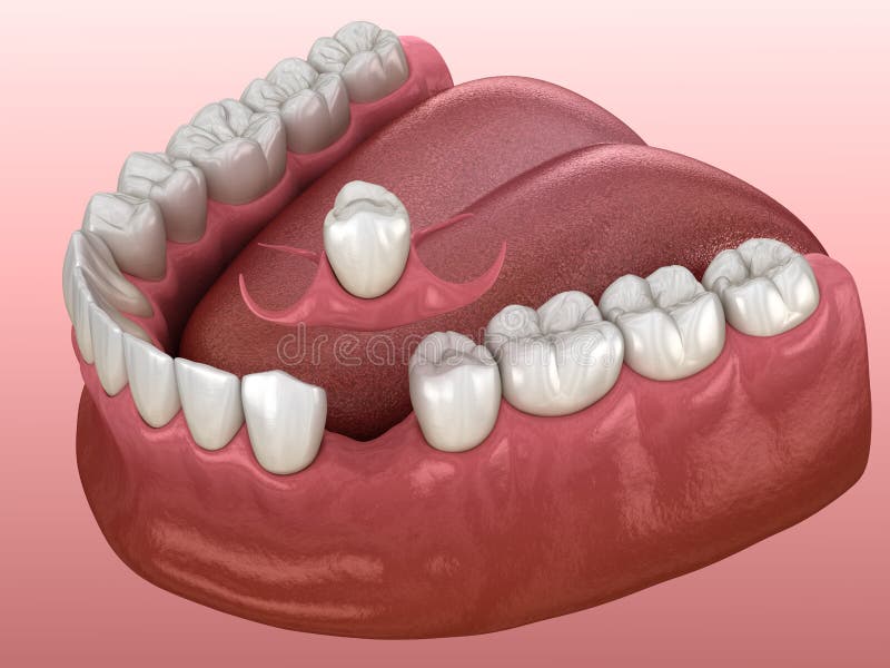 Partial Removable Immediate-denture Type Butterfly. Replacement of One ...