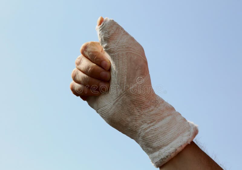 Osso Fratturato E Fasciatura Del Pollice Per Immobilizzare Il Dito ...