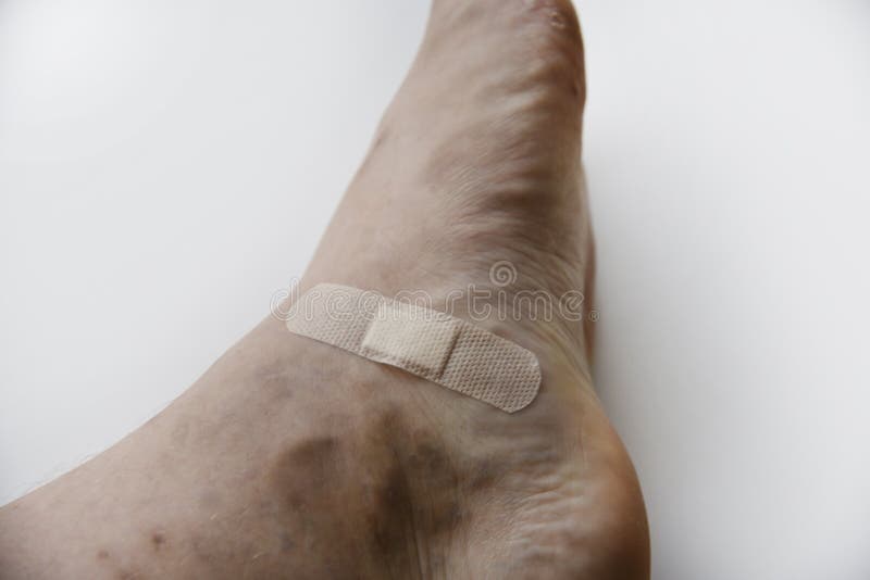 A Patch on a Man S White Leg. the Patch on the Leg Wound is a Close-up ...