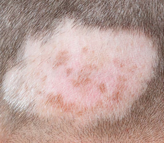 A Patch of Skin with a Red Mark on it Stock Image - Image of healthcare ...