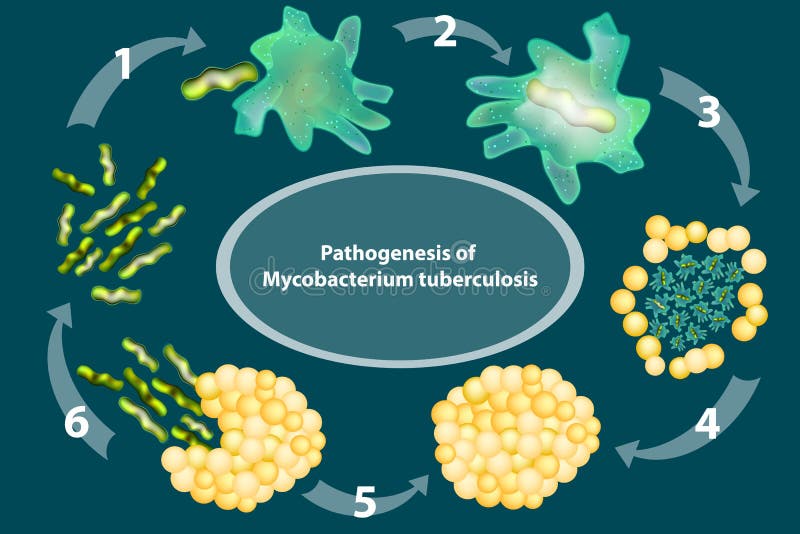 Pathogenesis of Mycobacterium Tuberculosis. Stock Vector - Illustration ...