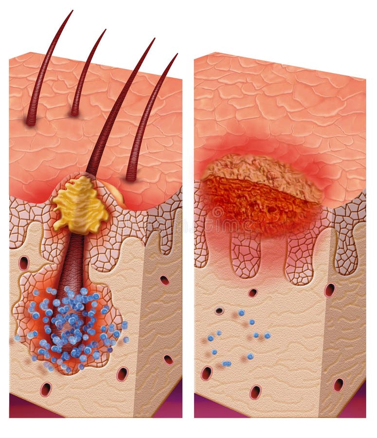 Pathogenic bacteria stock illustration. Illustration of bacteria - 29529205