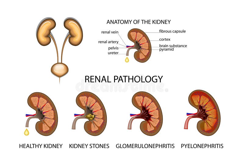 Pathologie des reins illustration de vecteur. Illustration du roches ...