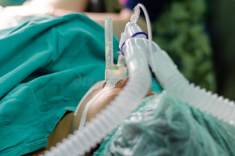 Patient with an Endotracheal Tube in Operation Theater Stock Image ...