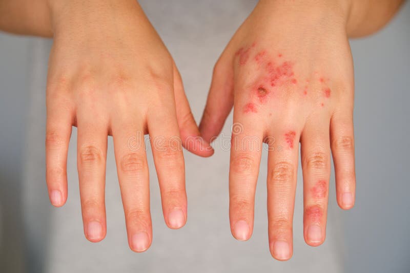 Eczema Comparison Stock Photos - Free & Royalty-Free Stock Photos from ...