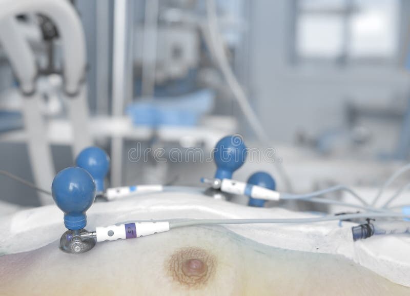 Patient with Heart Electrodes in ICU Stock Photo - Image of nurse ...