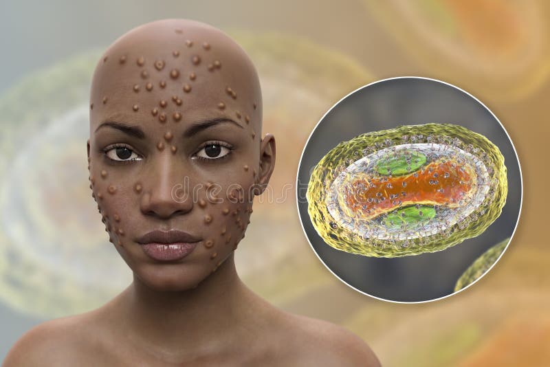 Patient with Monkeypox and Close-up View of Monkeypox Virus, 3D ...
