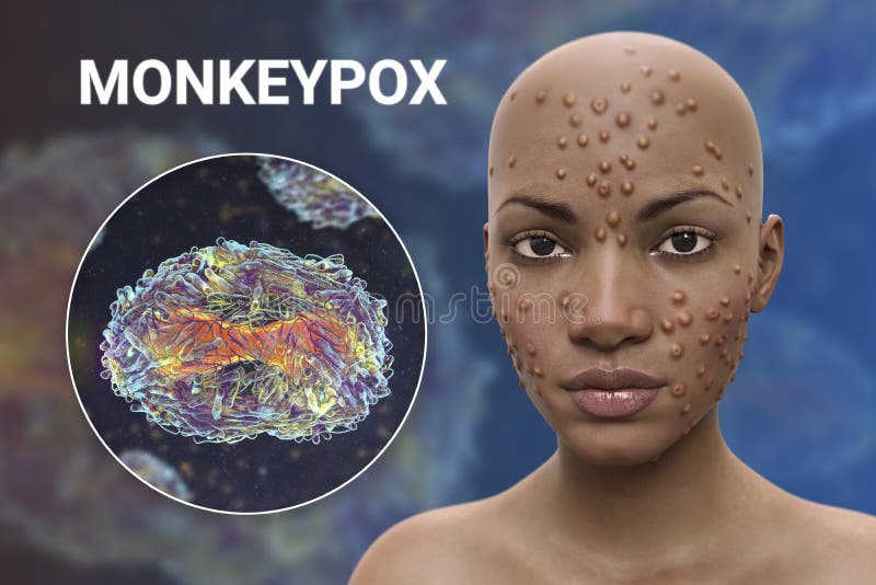 Patient with Monkeypox and Close-up View of Monkeypox Virus, 3D ...