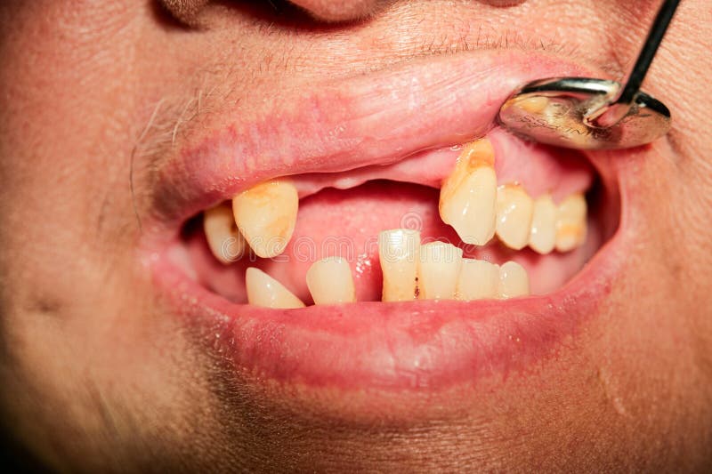 The Toothless Condition of a Patient. Stock Photo - Image of little ...