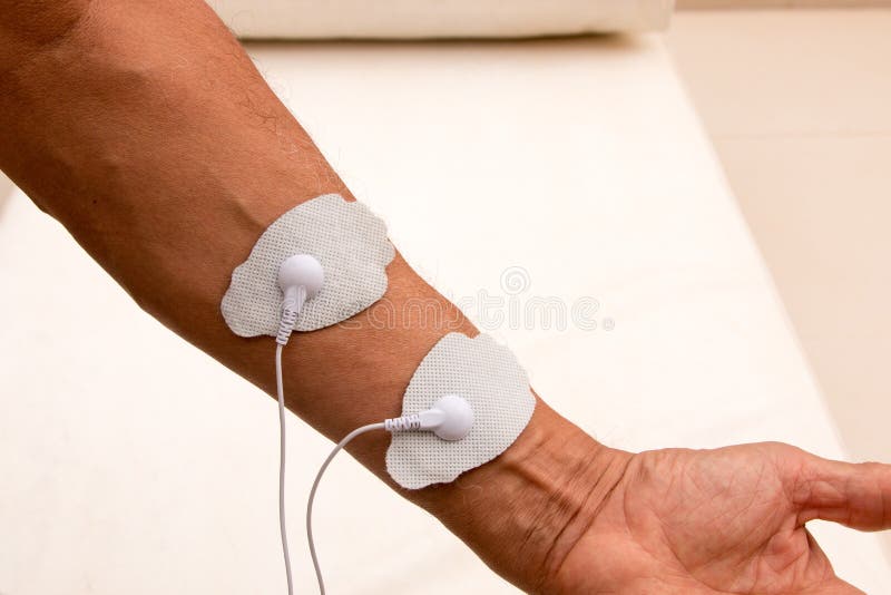 Electrodes Of Tens Device On Shoulder, Tens Therapy Stock Image - Image ...
