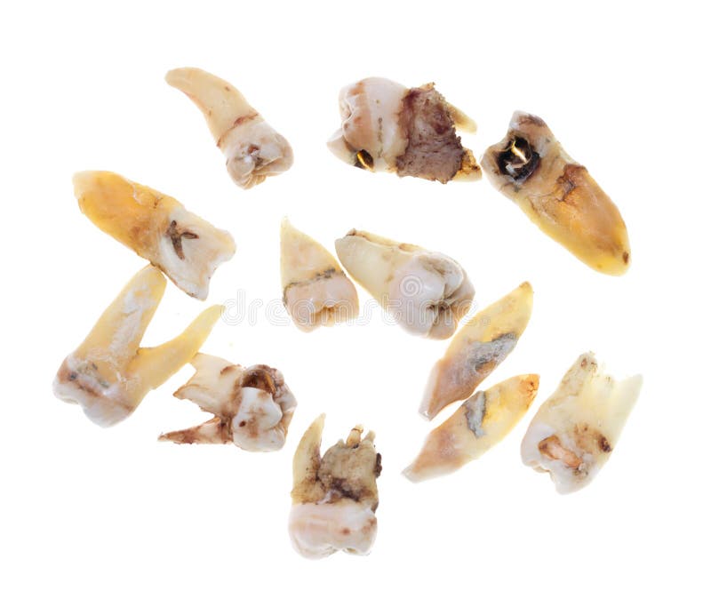 Patients Extracted Teeth on a White Background Stock Photo - Image of ...