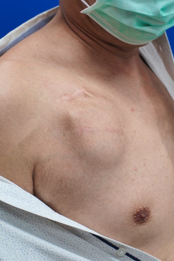 Patients with Problems Post Permanance Pacemaker. Stock Photo - Image ...