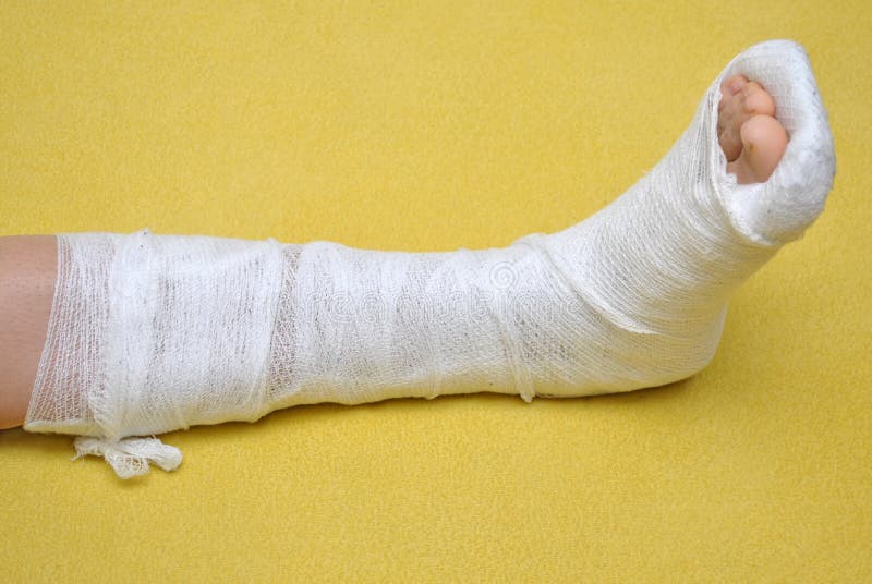 Patte cassée photo stock. Image of cassé, patte, humain - 18397120