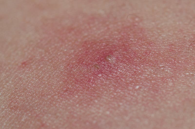 Peau allergique photo stock. Image du dermatologie, rouge - 33354492