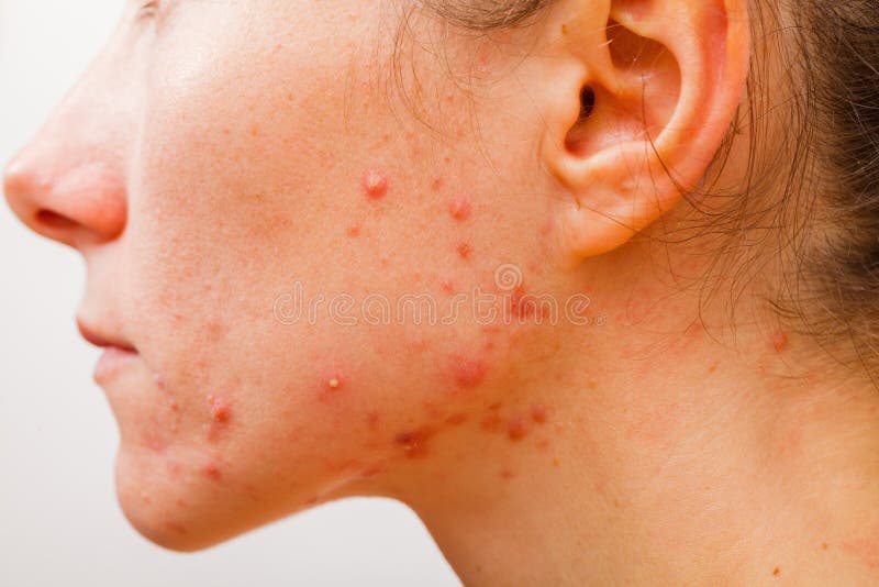 Acné. Pustules. Visage De Jeune Femme Avec Une Inflammation De La Peau ...