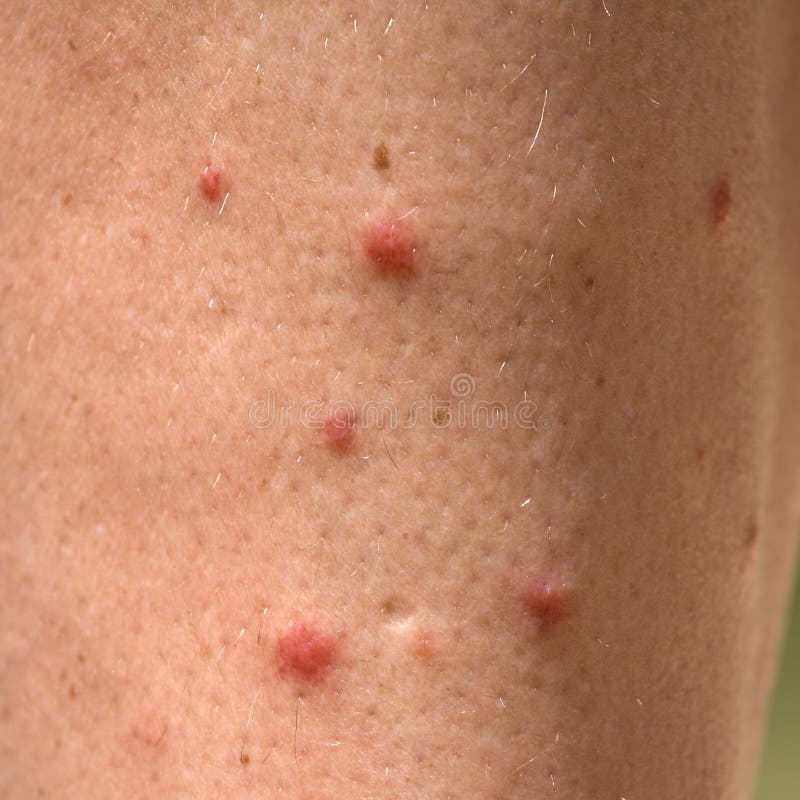 Peau Impétueuse Allergique D'eczema De Dermatite Sur La Jambe Du ...